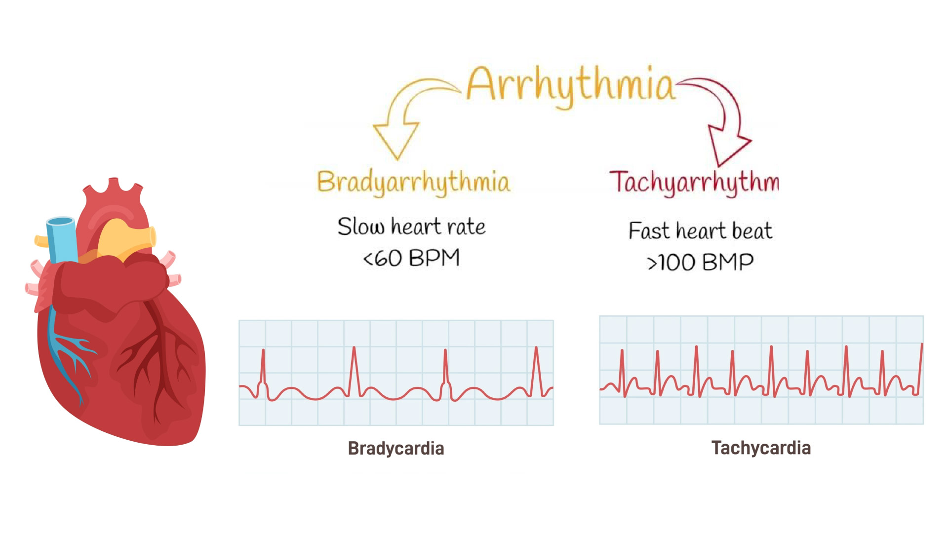 Tachycardia-Symptoms-Causes-Treatment-Healthy-Workout(1) - Health Tips